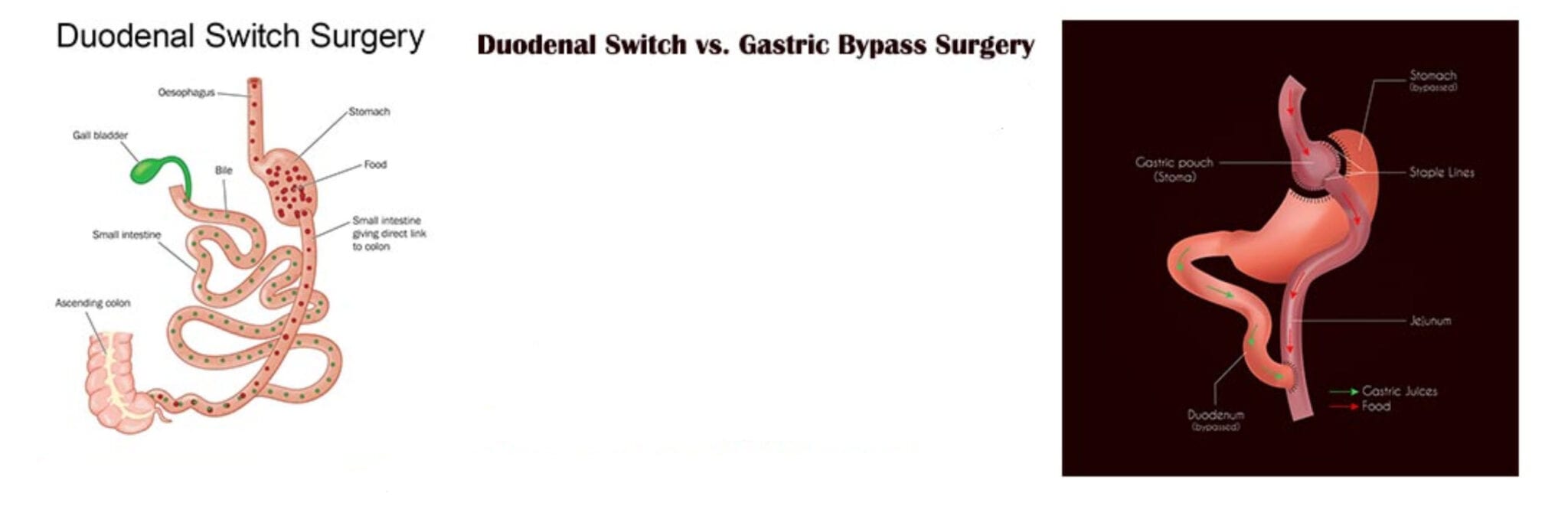 Duodenal Switch Surgery | Tijuana, Mexico | Vida Wellness & Beauty