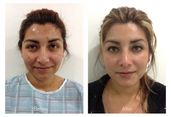 How Much Does a Nose Job Cost in Mexico? A Guide to Mexico Rhinoplasty Cost