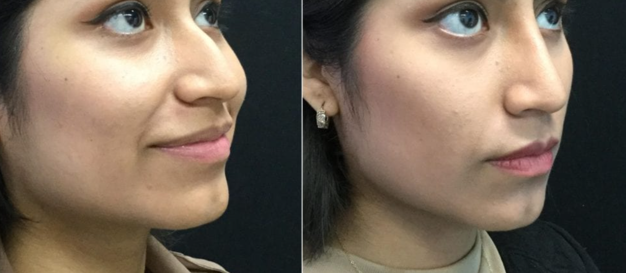 Rhinoplasty 101: All About Nose Jobs - VIDA Wellness and Beauty
