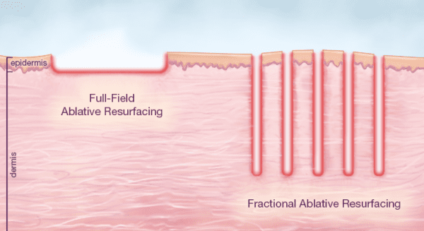 Dermablate: Laser Skin Resurfacing - VIDA Wellness and Beauty