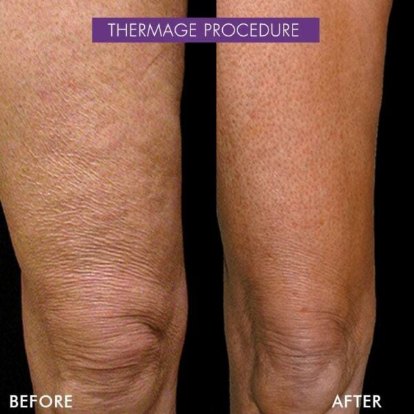 Thermage Skin Tightening in Tijuana, MX | VIDA Wellness & Beauty