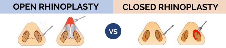 Open vs. Closed Rhinoplasty: How Do You Get a Scarless Nose Job? - VIDA ...