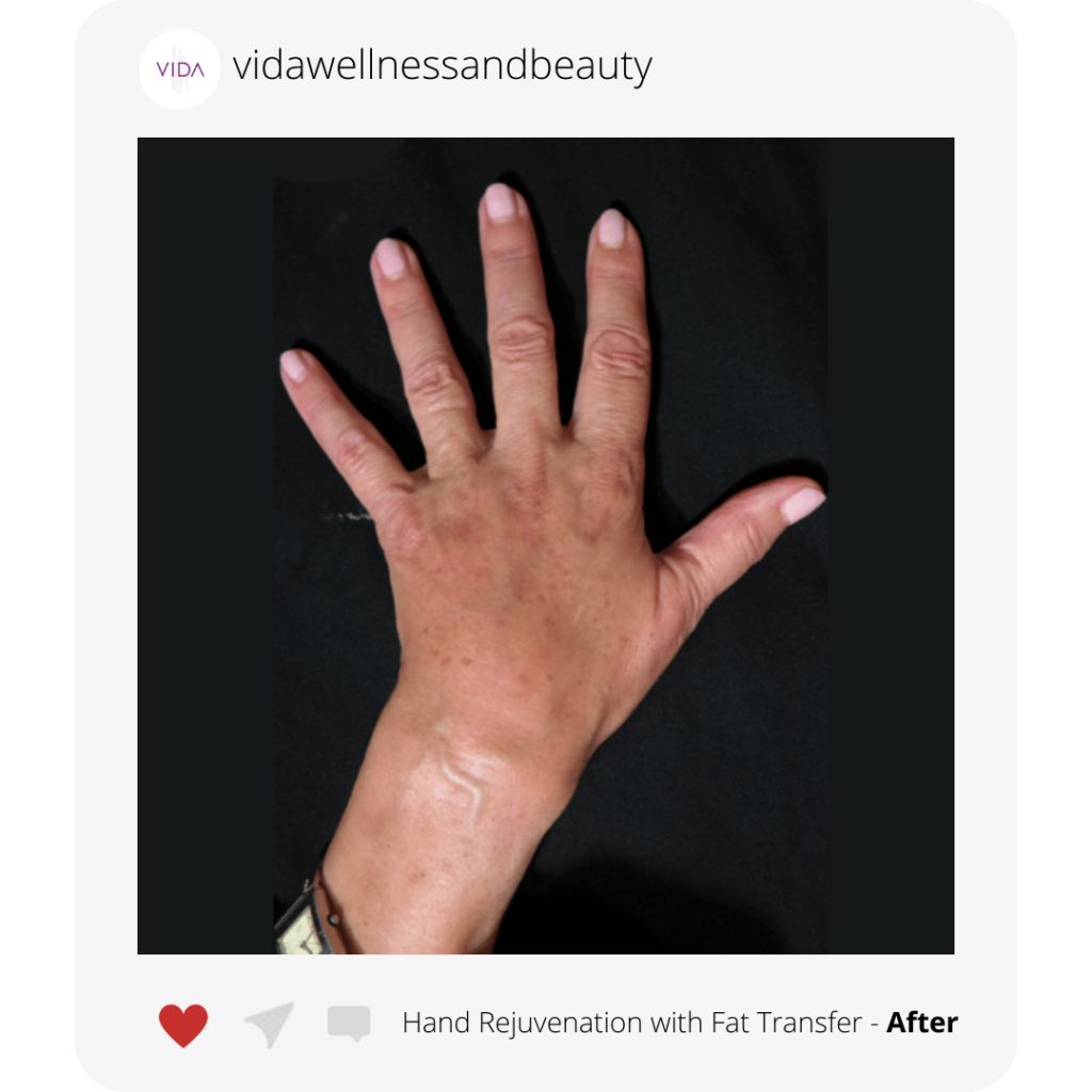 Hand rejuvenation and what you need to know - VIDA Wellness and Beauty