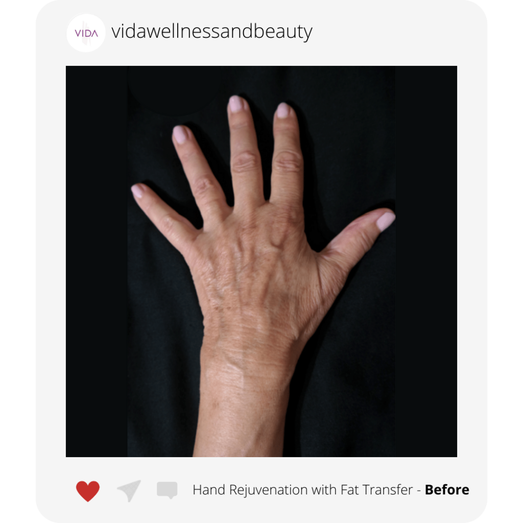 Hand Fat Transfer Leaves Hands with a Younger, Rejuvenated Look - VIDA ...