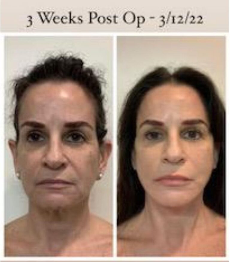 Recovery After Your Facelift: A 30-Day Guide - VIDA Wellness and Beauty