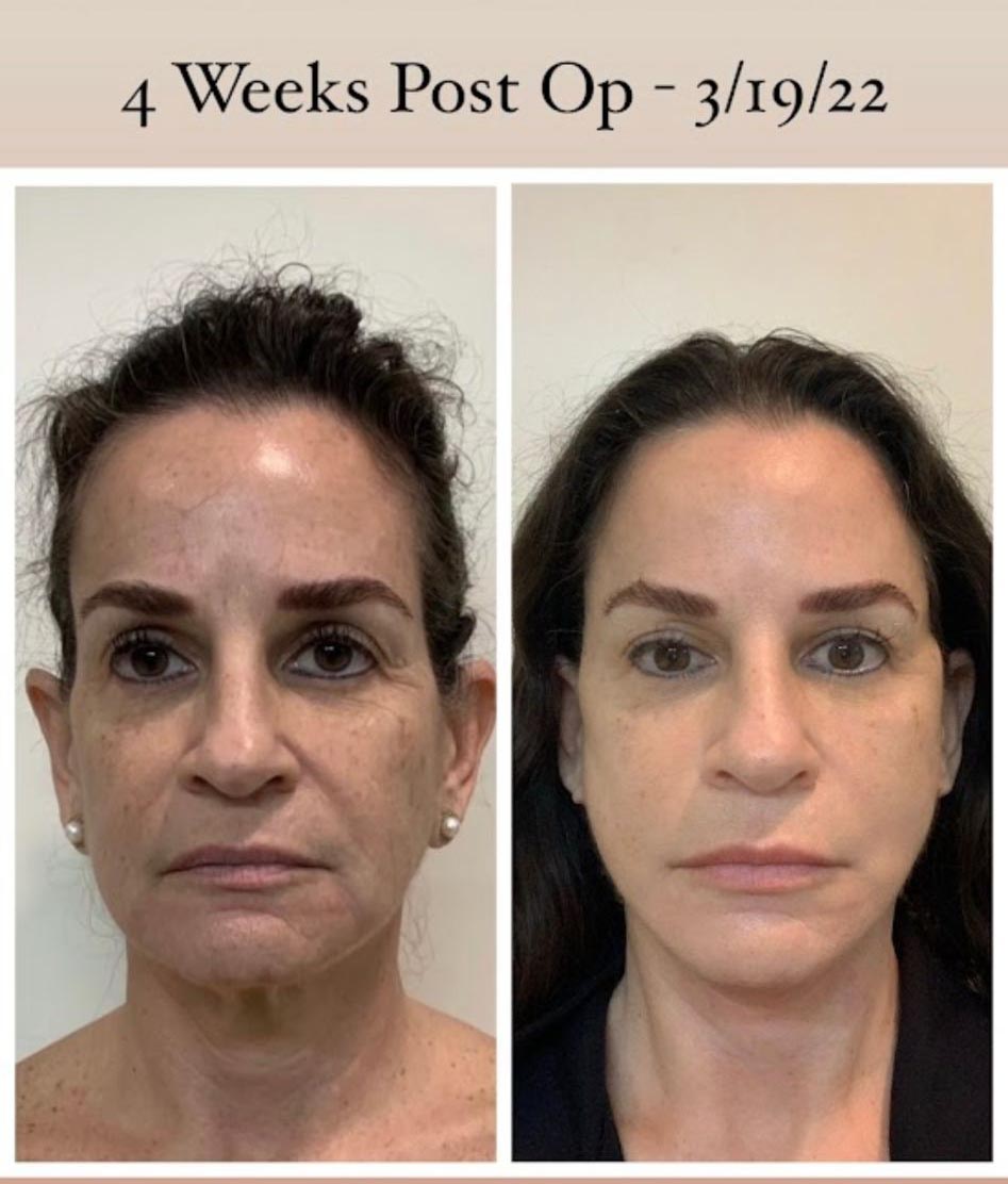 Recovery After Your Facelift: A 30-Day Guide - VIDA Wellness and Beauty