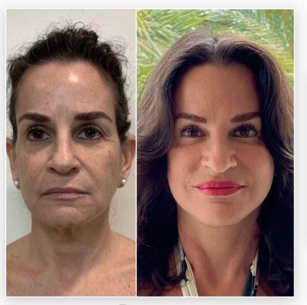 Recovery After Your Facelift: A 30-Day Guide - VIDA Wellness and Beauty