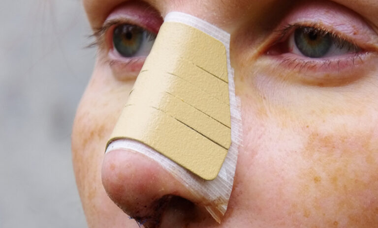 Wide Nose Rhinoplasty (Nose Jobs for Wide Noses): A Complete Guide