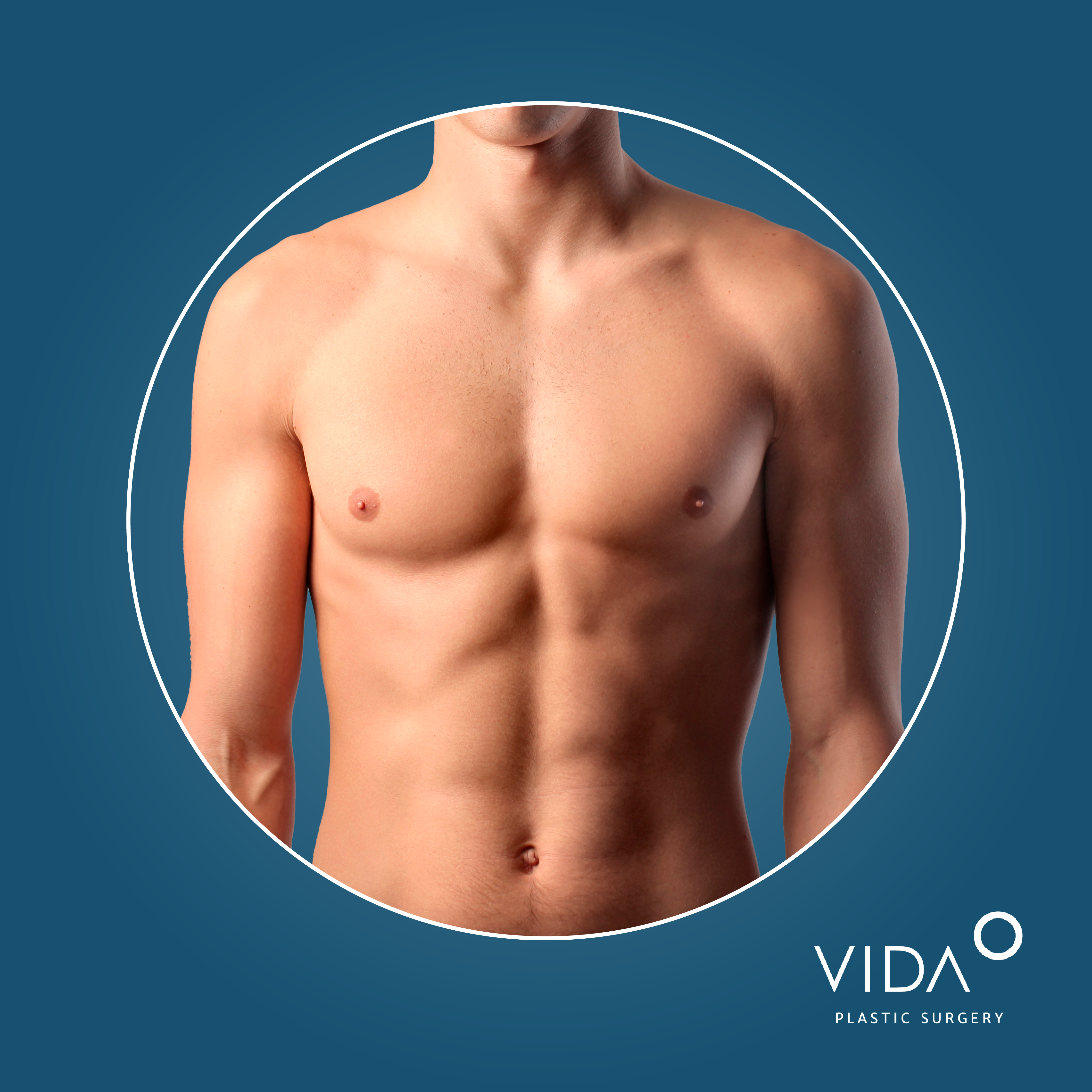 Type 1 Gynecomastia