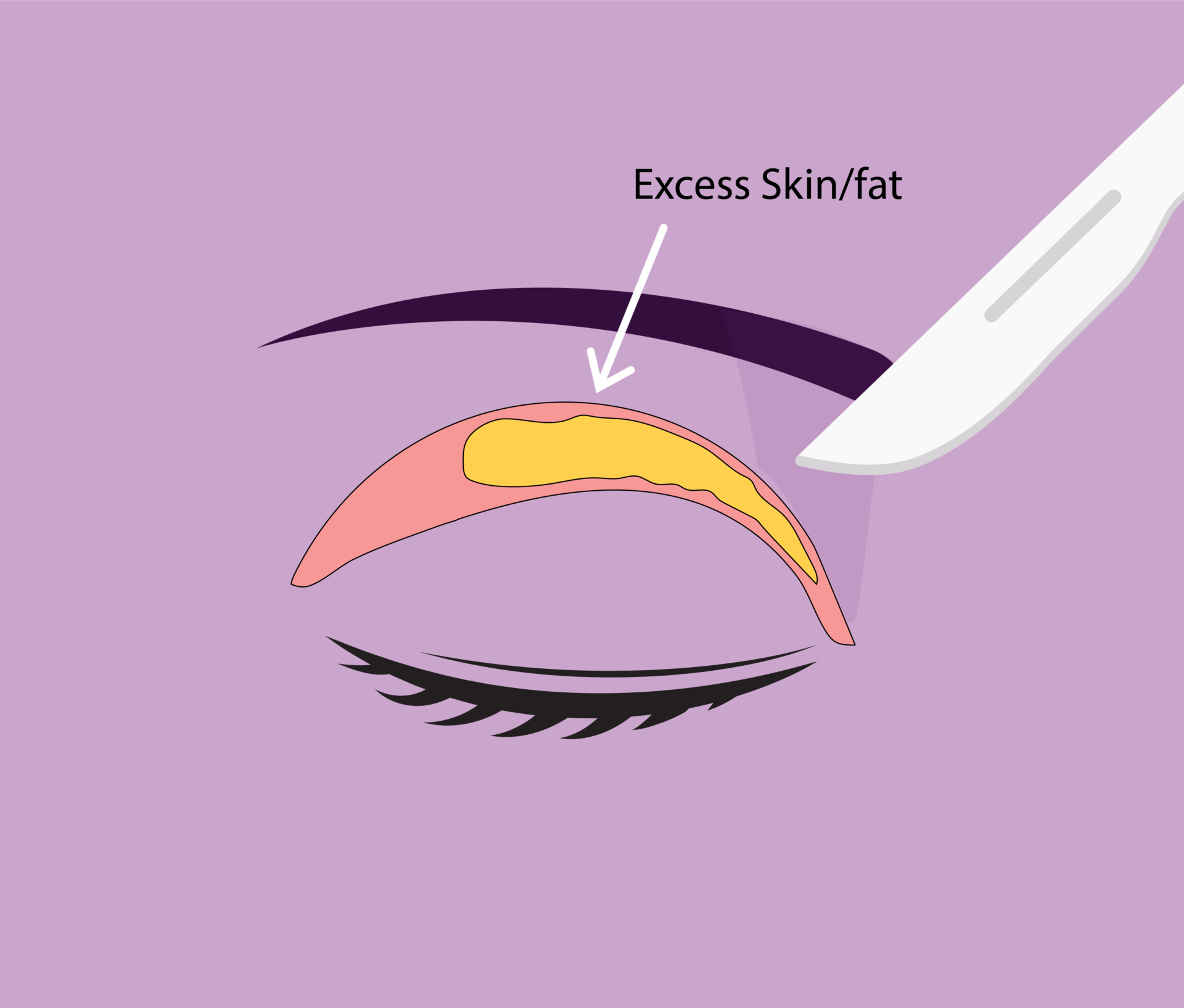 Asymmetrical Eyes: How to Fix Asymmetrical, Uneven, and Droopy Eyelids
