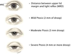How to Fix Uneven Eyelids - VIDA Wellness and Beauty