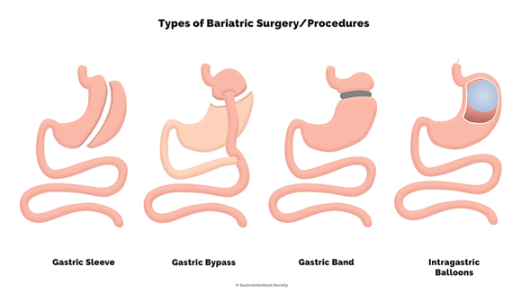 Bariatric Surgery Pros and Cons: Is It Worth The Risk?