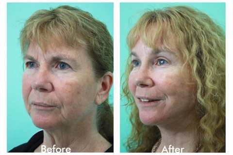 Facelift - VIDA Wellness and Beauty